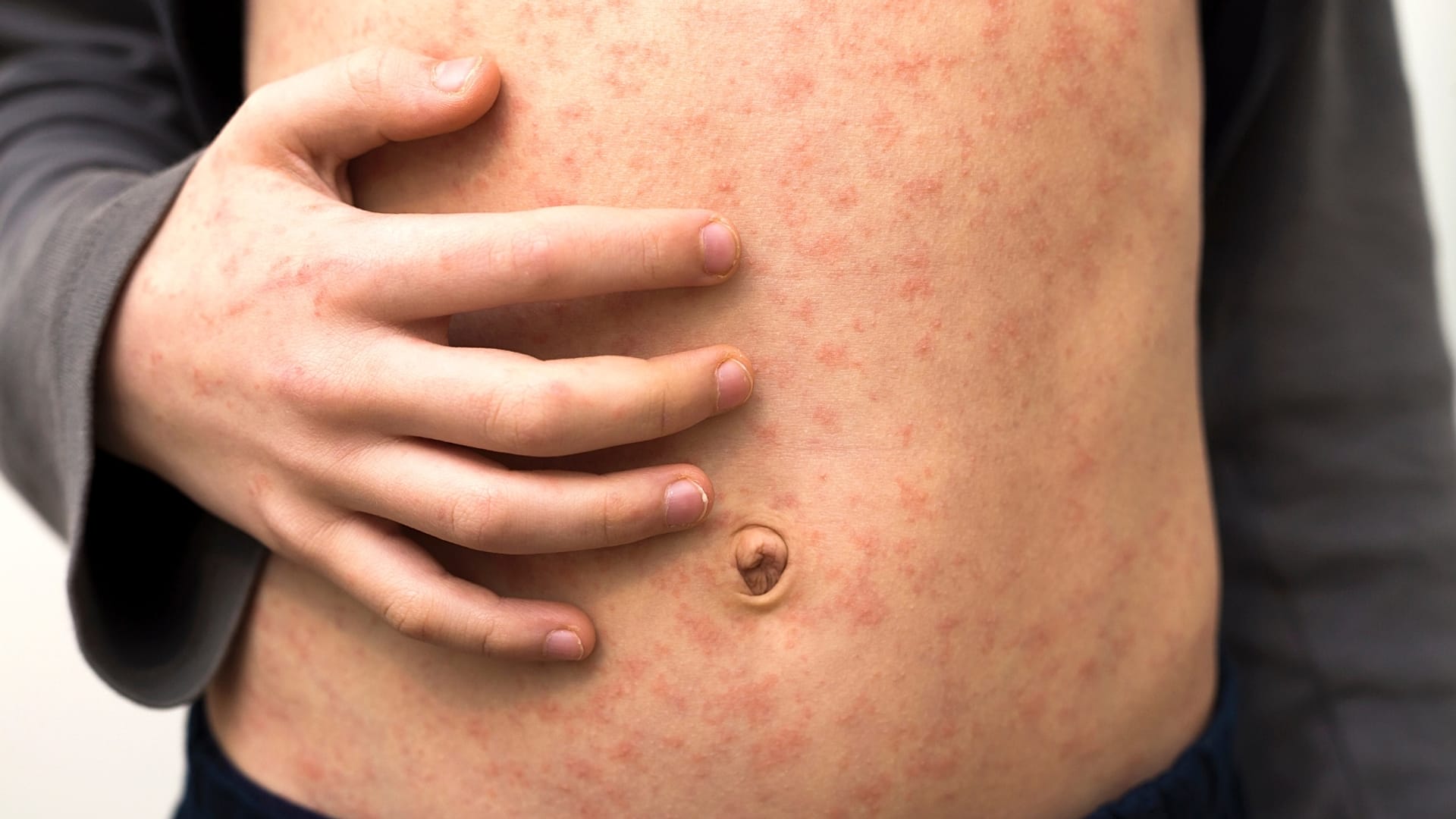 Measles in Europe: Tracking cases of one of the world's most contagious ...