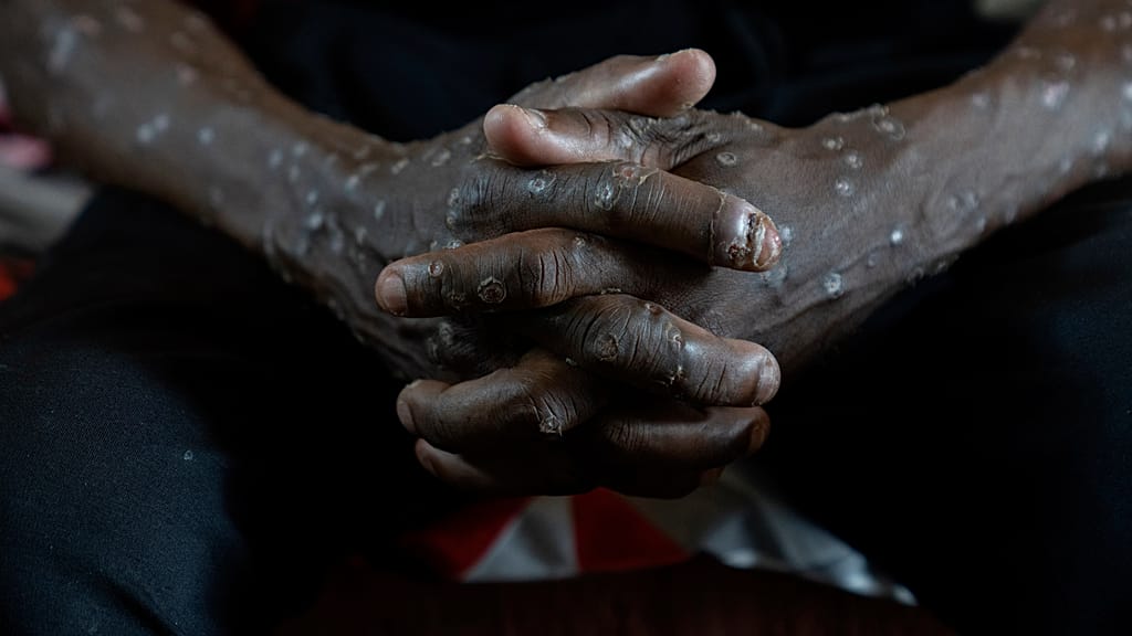 Congo declares end of two-year mpox outbreak that killed over 2,000 ...
